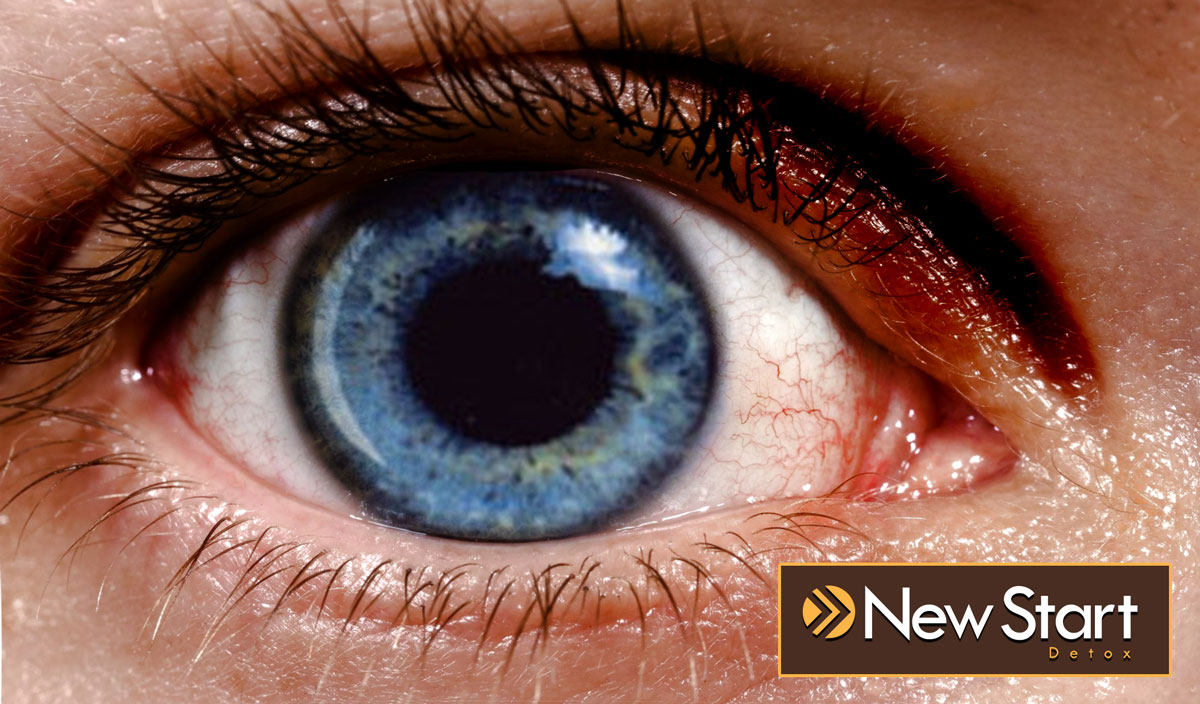 2 Ways Narcotics Hijack the Human Pupil - New Start Recovery